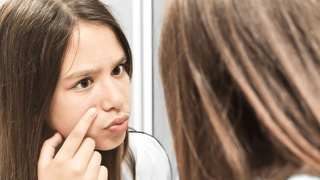 How to deal with kid's acne | Michigan Medicine