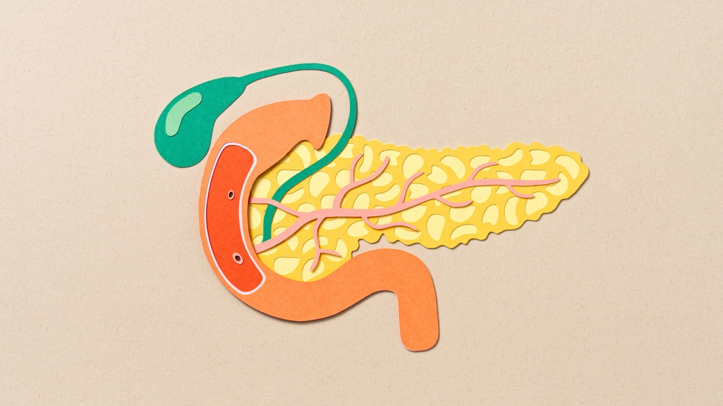 Avoiding recovery delays with hospitalized pancreatitis | Michigan Medicine