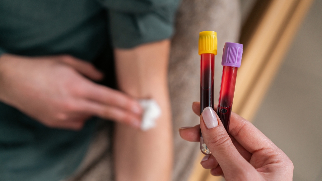 Using gene expression in blood to personalize care for APS | Michigan ...