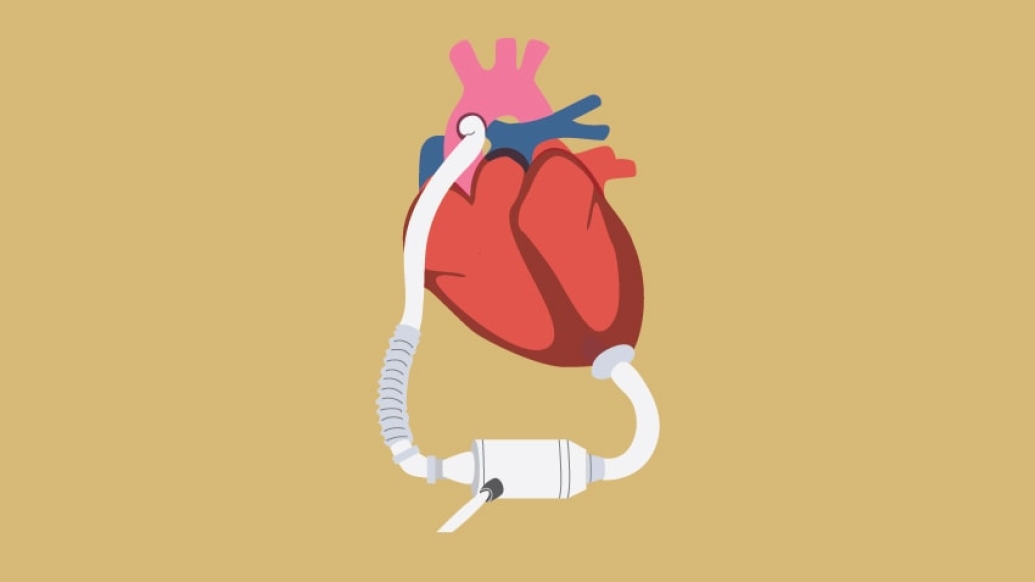Life with a Ventricular Assist Device: A Nurse Answers Common Questions