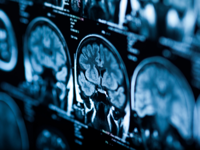 Diagnosing Chronic Traumatic Encephalopathy (CTE) in Living Patients