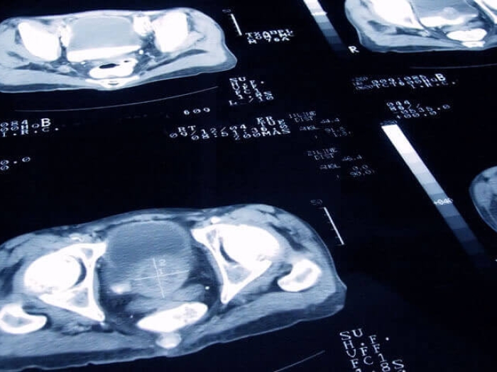 5 things to know about prostate enlargement and treatment options ...