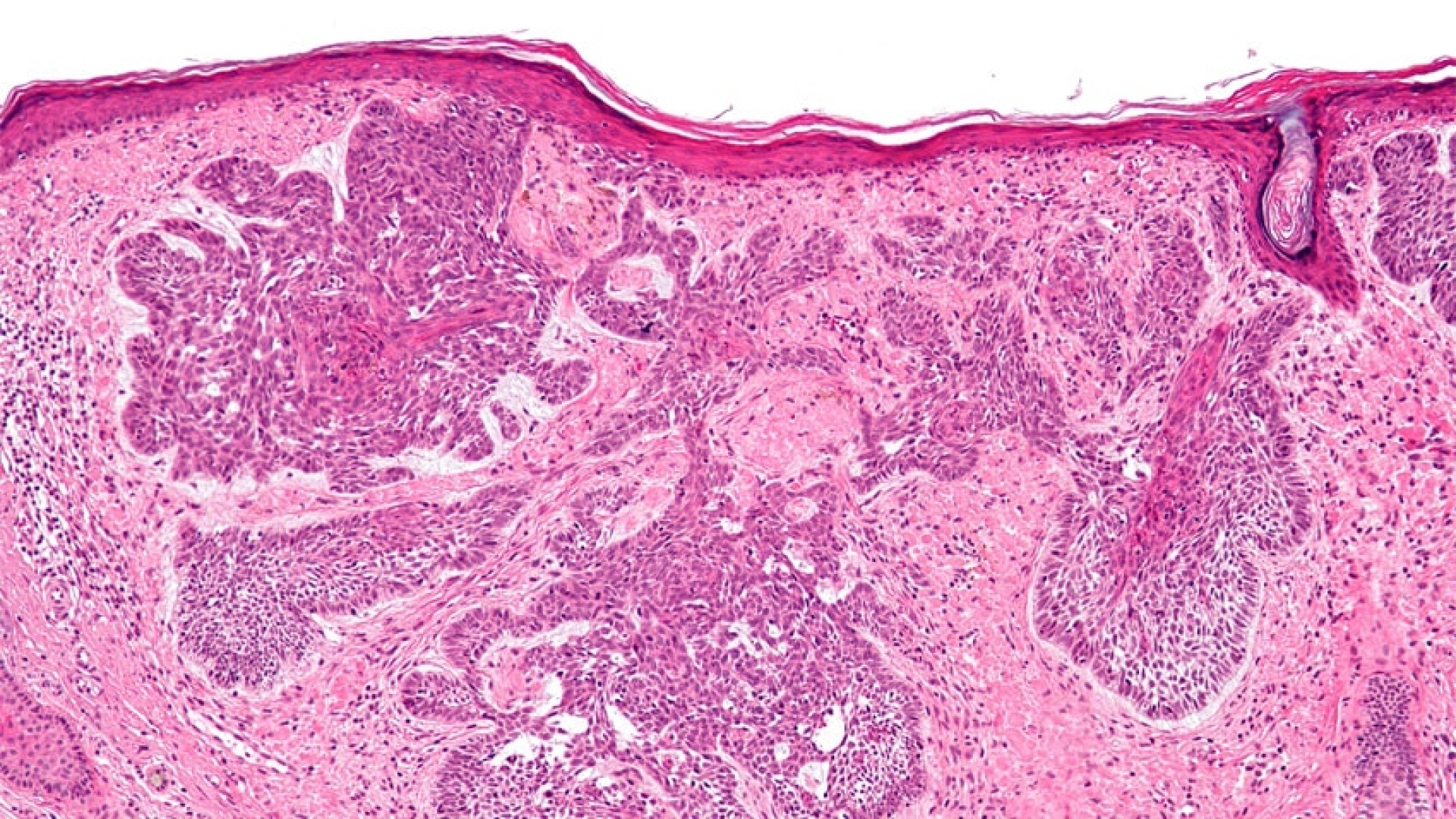 Biomarker Helps Identify Skin Cancer | Michigan Health Lab
