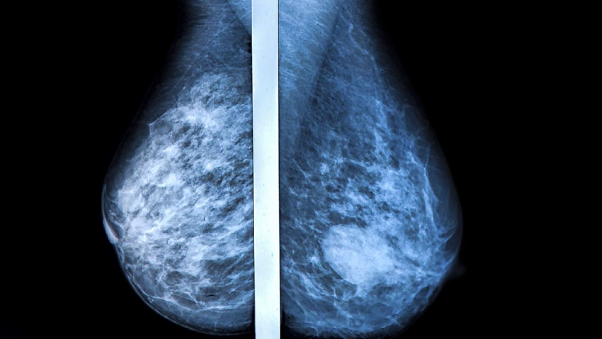 Elective Mastectomy: Why More Women Are Having Voluntary Mastectomies
