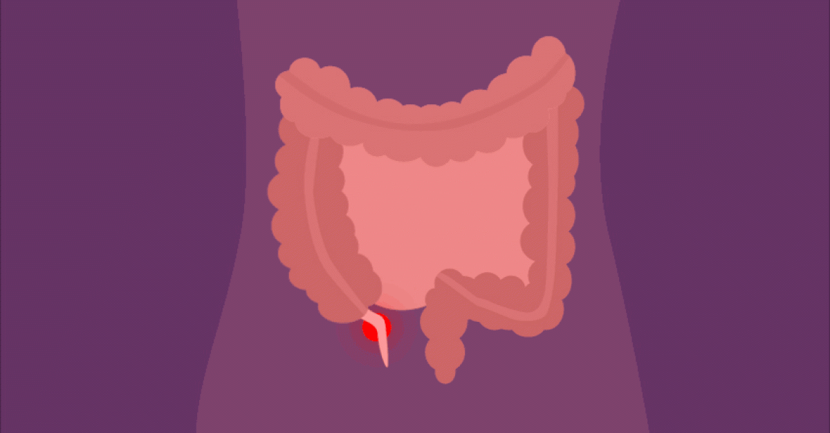 Why is Appendicitis Not Always Diagnosed in the Emergency Department?